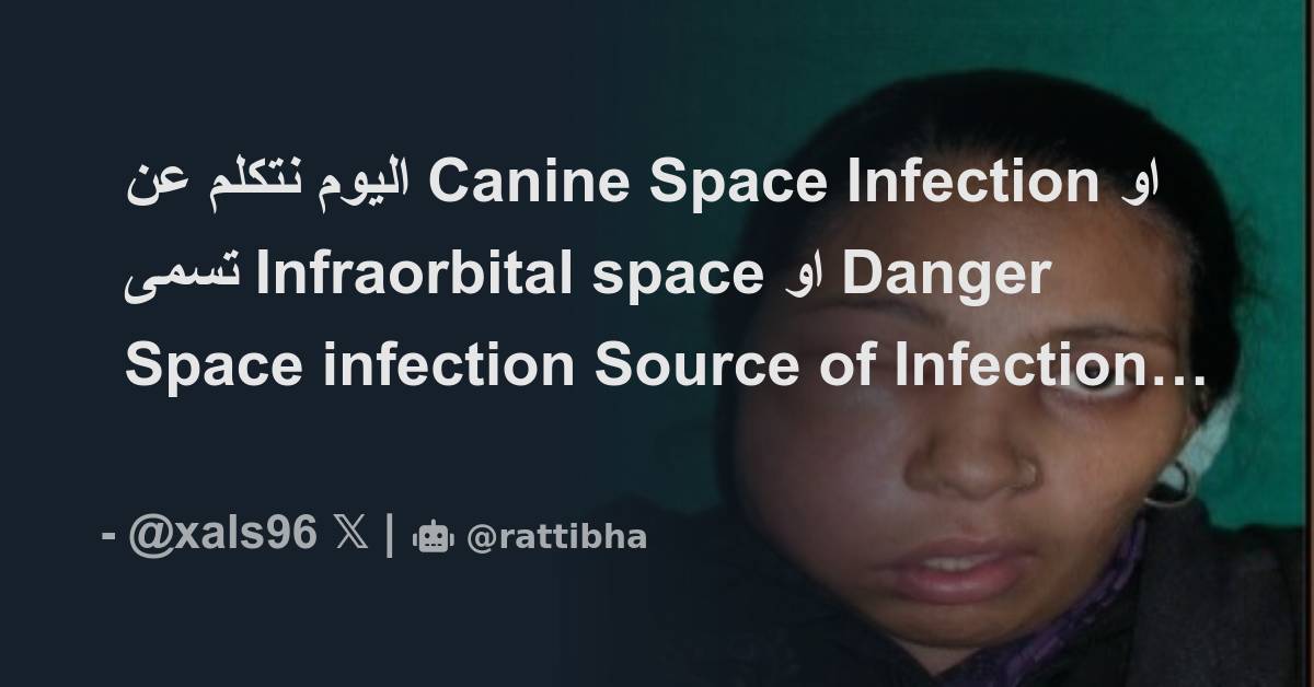 اليوم نتكلم عن Canine Space Infection او تسمى Infraorbital space او ...
